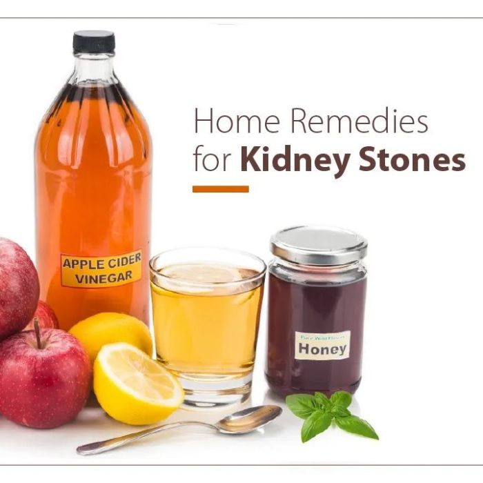 Extracorporeal Shock Wave Lithotripsy (ESWL): Procedure and Benefits ...