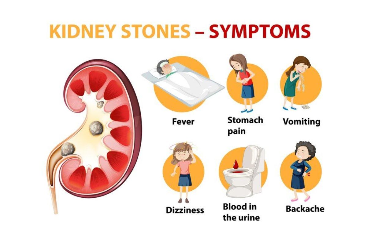 Early Signs of Kidney Stones: Symptoms You Should Notice